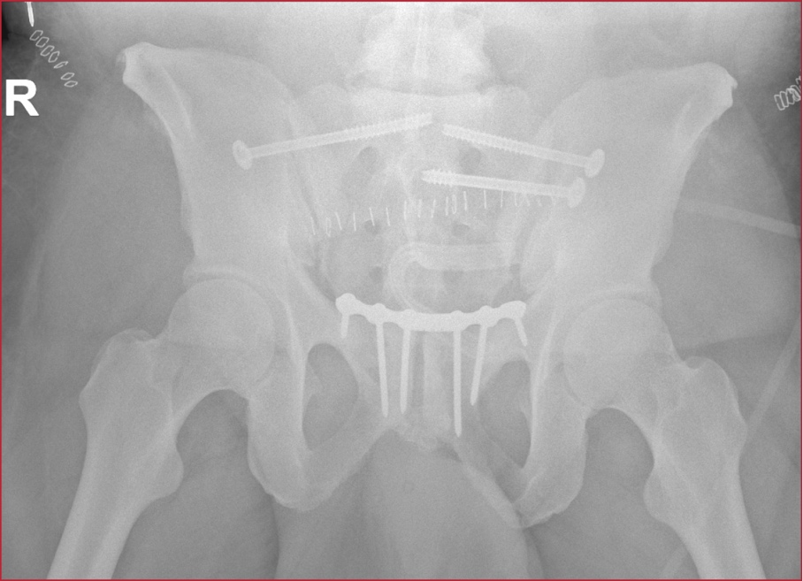 Figura 3. Radiografía tras la fijación y osteosíntesis del anillopélvico.